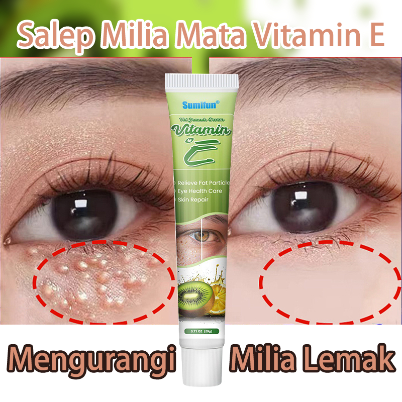 Jual Penghilang Milia Paling Ampuh Eye Cream Milia Remover Obat Milia ...