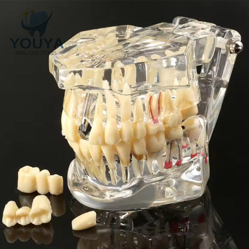 Jual Model study gigi edukasi transparan studi implant phantom crown karies bridge bening ...