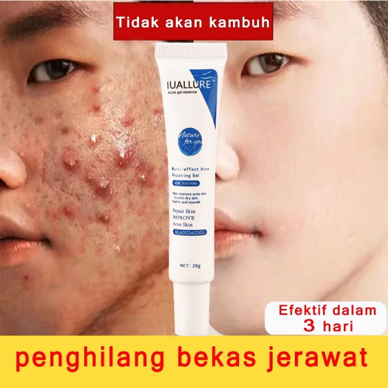 Jual IUALLURE Acne Cream salep Jerawat dan bekas Removal cream Obat ...