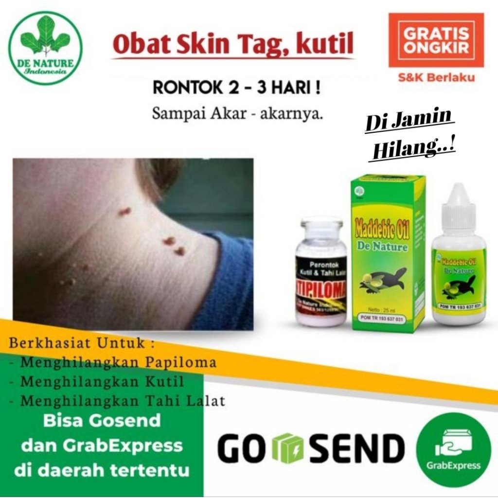 Jual Obat Skin Tag, Penghilang Daging tumbuh di Leher, Wajah, Kelamin ...