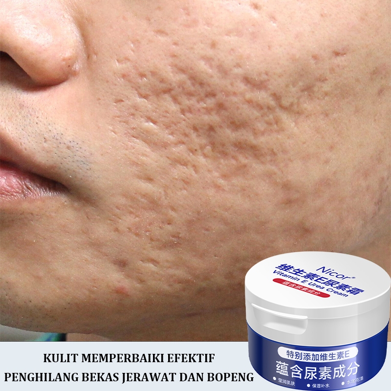 Jual penghilang bekas jerawat Krim Vitamin E 100g penghilang bopeng ...