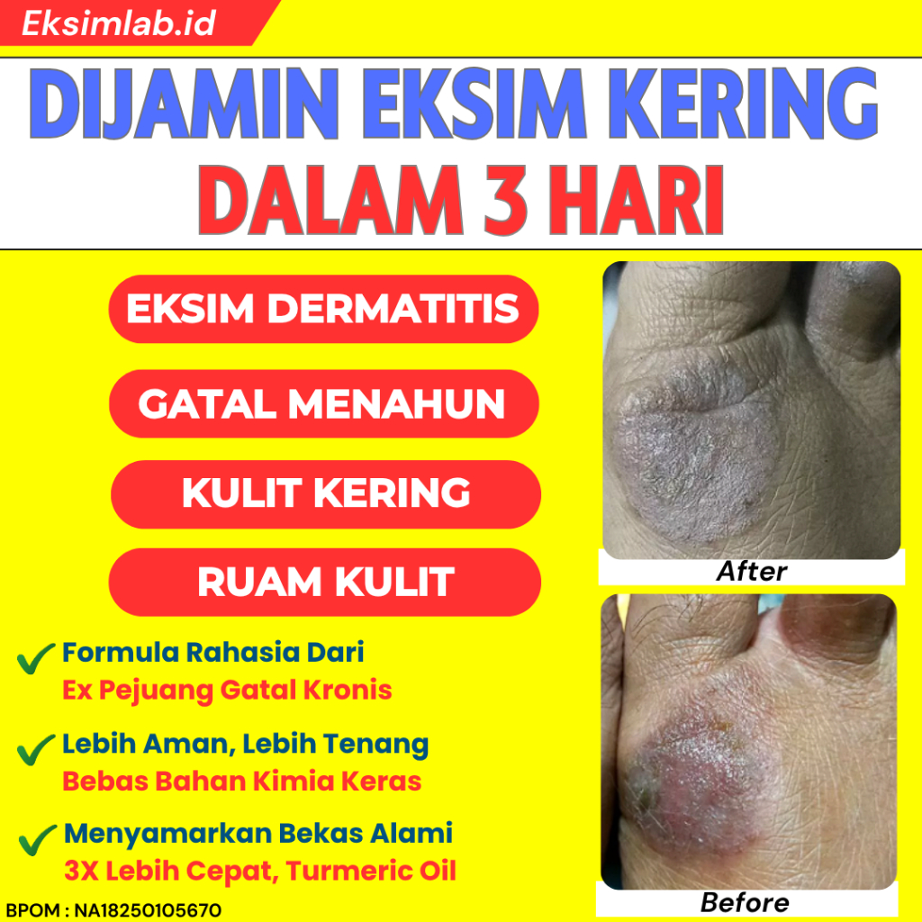 Jual Obat Gatal Kulit Paling Ampuh Eksim Exim Basah Kering Jamur Kulit ...