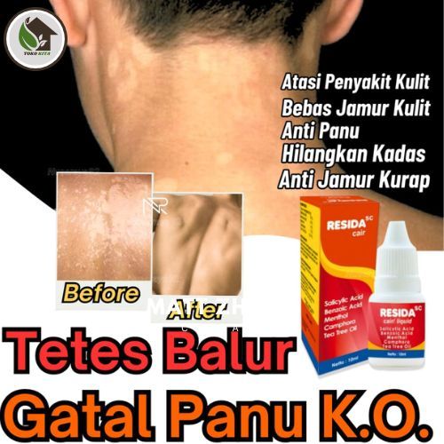 Jual Resida Kapsul 0bat Gatal Kulit Obat Bisul Ampuh/Krim Salep ...