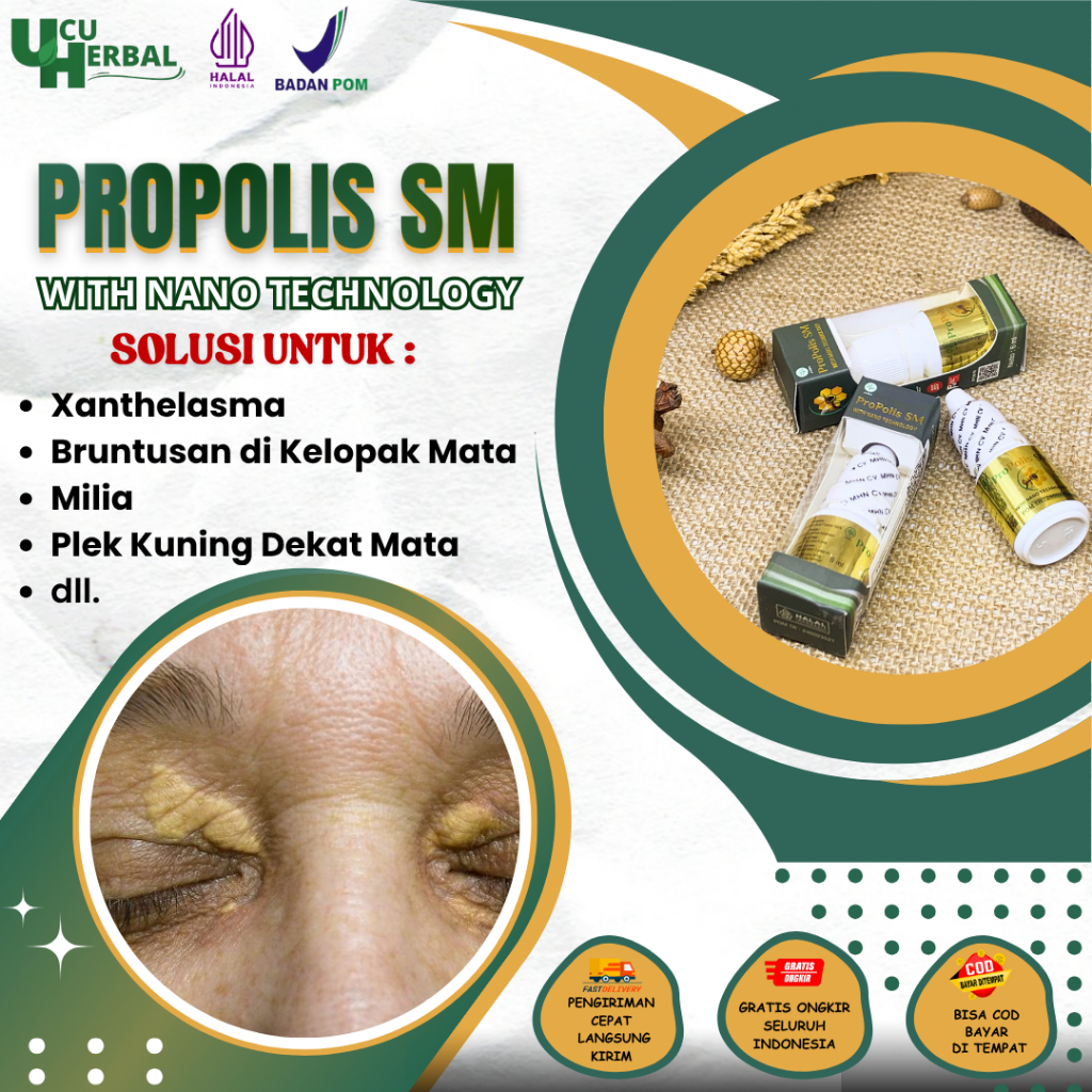 Jual Propolis SM - Obat Penghilang Xanthelasma, Obat Bruntusan di ...