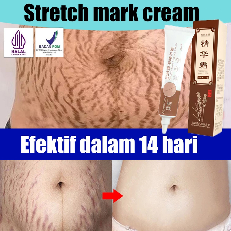 Jual Stretch mark cream Salep strechmark paling ampuh Cream stretch ...