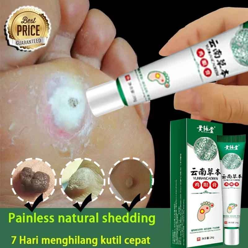 Jual Obat Mata Ikan Salep Mata Ikan Obat Kutil Kapalan Mata Ikan Kaki ...