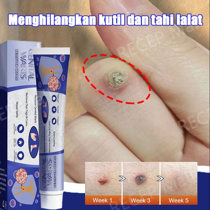 Jual Pengilang Kutil Dan Tahi Latat Obat Kutil Salep Kutil Skin Tag ...