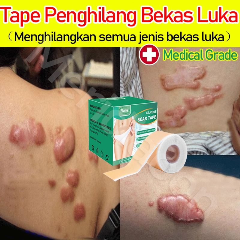Jual Silicone scar sheet Plester bekas luka Penghilang bekas luka Scar ...