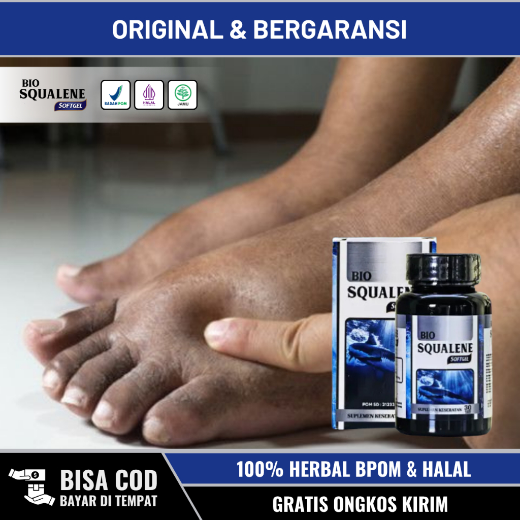 Jual Obat Kaki Bengkak Karena Gula / Diabetes, Asam Urat, Ginjal ...