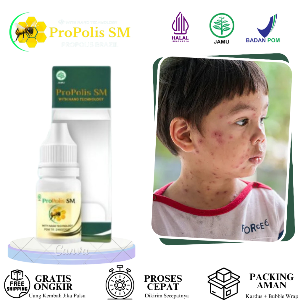 Jual Obat Cacar Air & Bekas Cacar Varicella Zoster Cacar Api Herpes ...