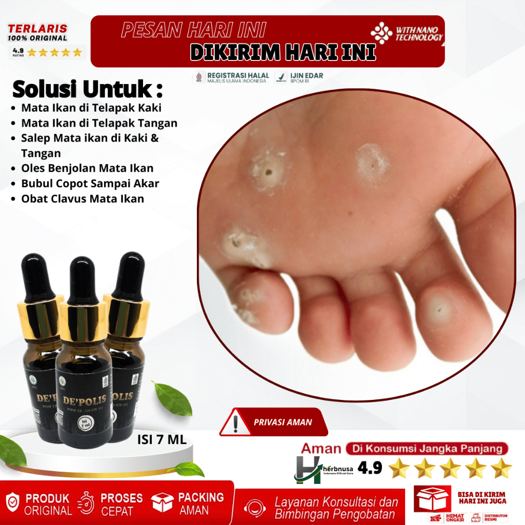 Jual Obat Mata Ikan di Telapak Kaki, Obat Mata Ikan di Telapak Tangan, Salep Mata ikan di Kaki ...