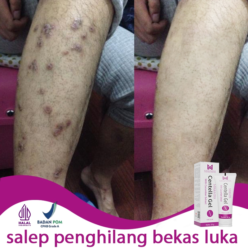 Jual Penghilang bekas luka hitam koreng salep penghilang bekas luka ...