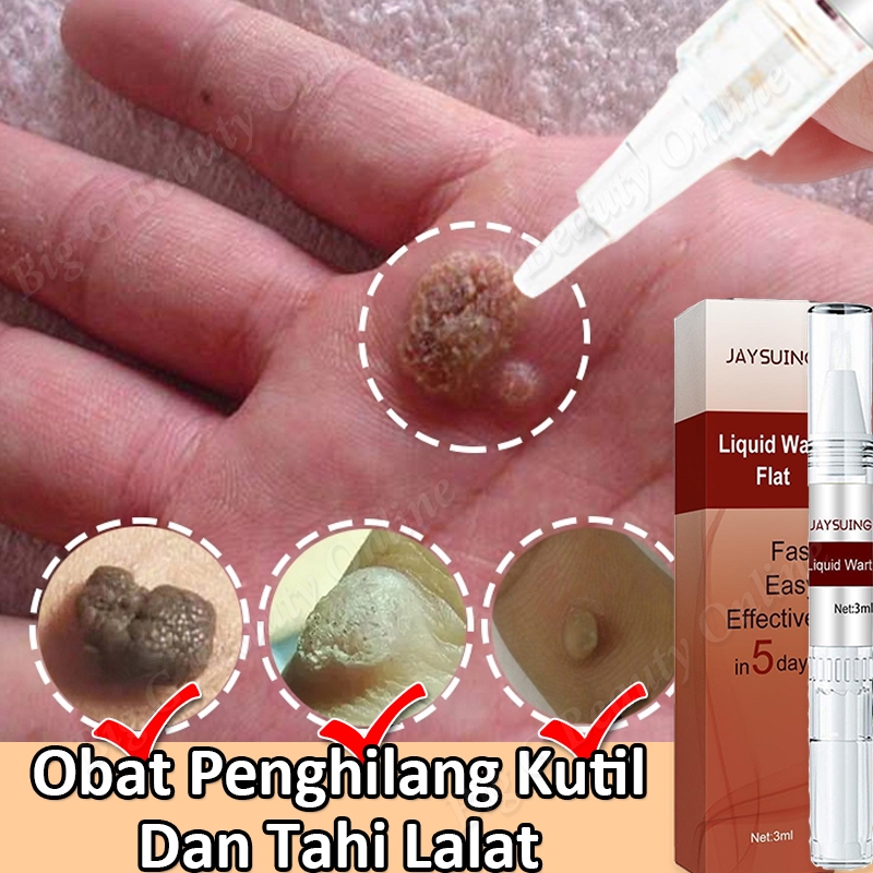 Jual Obat Penghilang Kutil Dan Tahi Lalat Penghilang Tahi Lalat Di ...