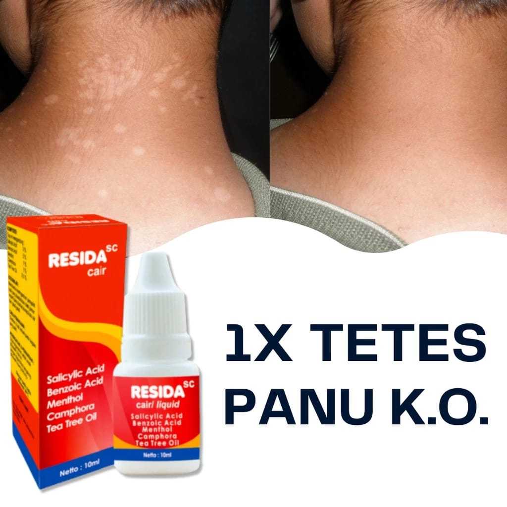 Jual PAKET 2 RESIDA Kadas Kurap Gatal Gatel Kutu Air Kulit Selangkangan ...