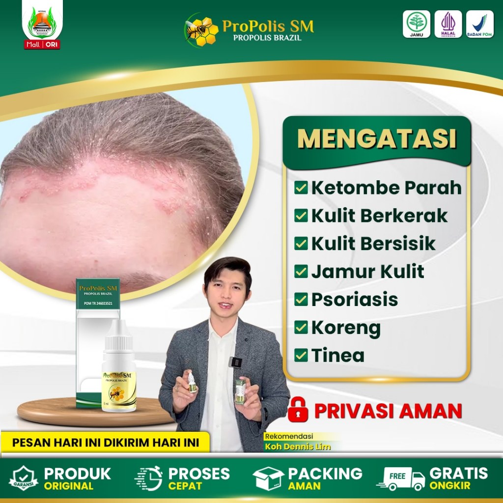 Jual Obat Borok Di Kepala, Ketombe Parah Kering Berkerak, Kulit Kepala Bersisik dan Berkerak ...