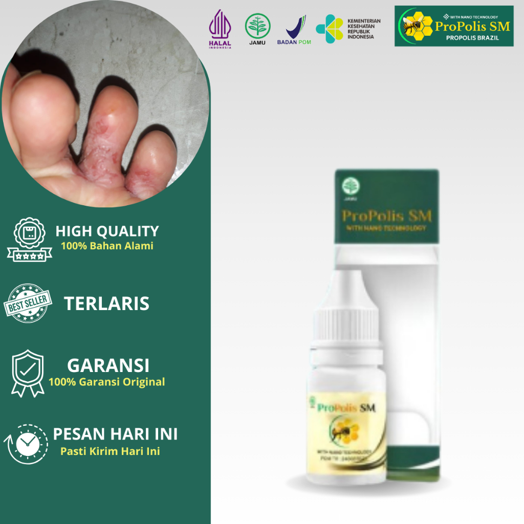 Jual Obat Kutu Air Pada Sela Jari kaki Gatal Parah Di Tangan Penghilang ...