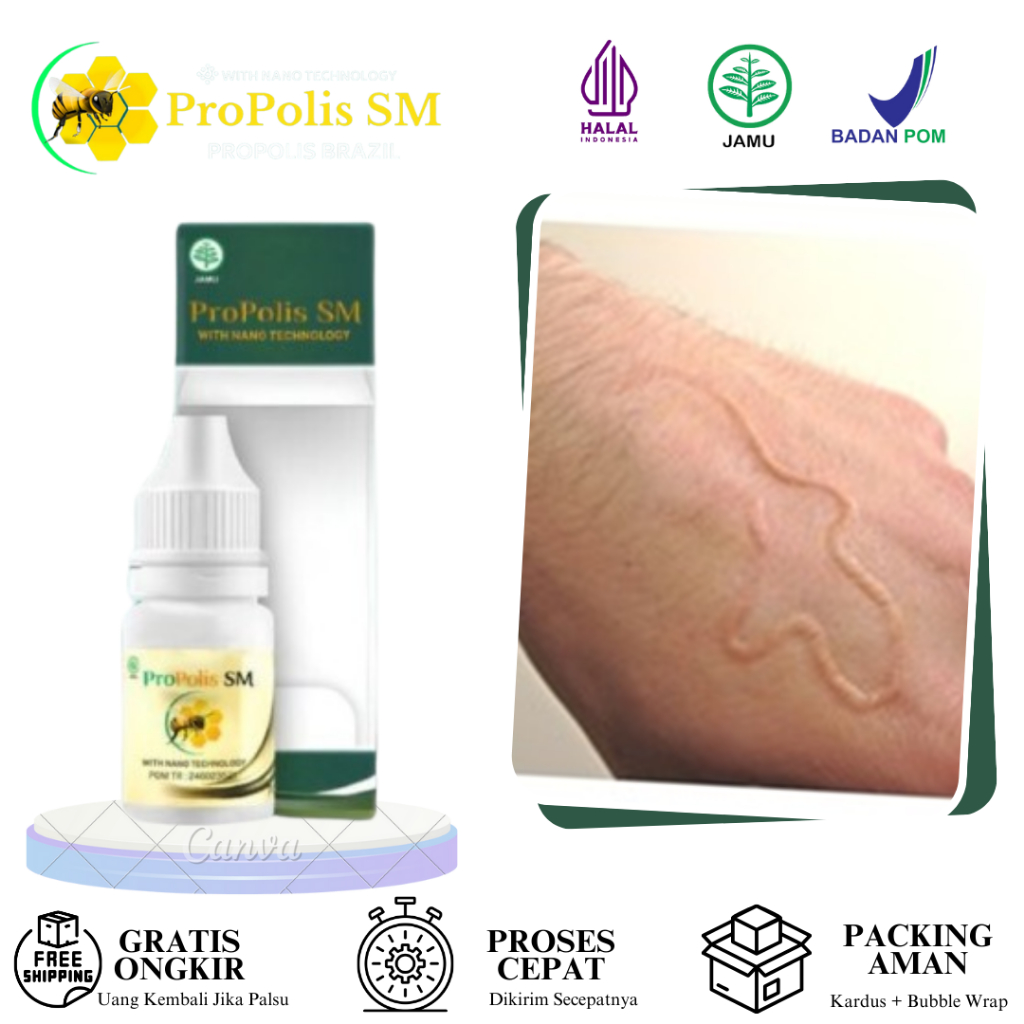 Jual Obat Cutaneous Larva Migrans Infeksi Cacing Kulit Larva Cacing ...
