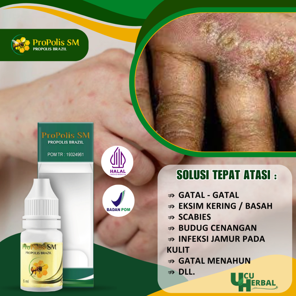 Jual Obat Tetes Gatal Budug, Obat Infeksi Jamur Kulit, Obat Penghilang ...