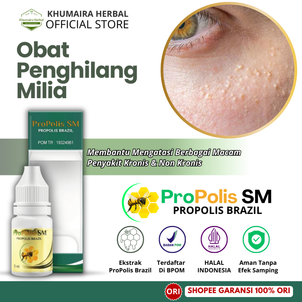 Jual Propolis SM - Obat Milia Di Bawah Kelopak Mata Bintik Putih Bercak ...