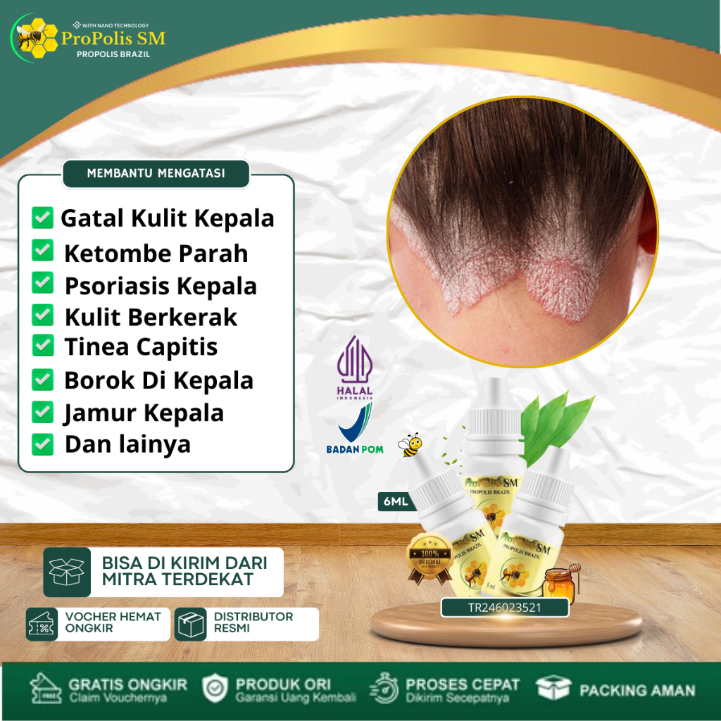 Jual Propolis SM - Obat Psoriasis di Kepala Jamur Di Kulit Kepala Tinea Capitis Kurap Kepala ...