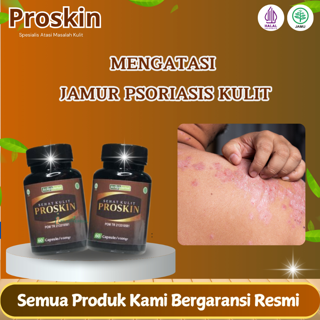 Jual Obat Jamur Psoriasis Kulit Bersisik Gatal Berair Bernanah Kulit ...
