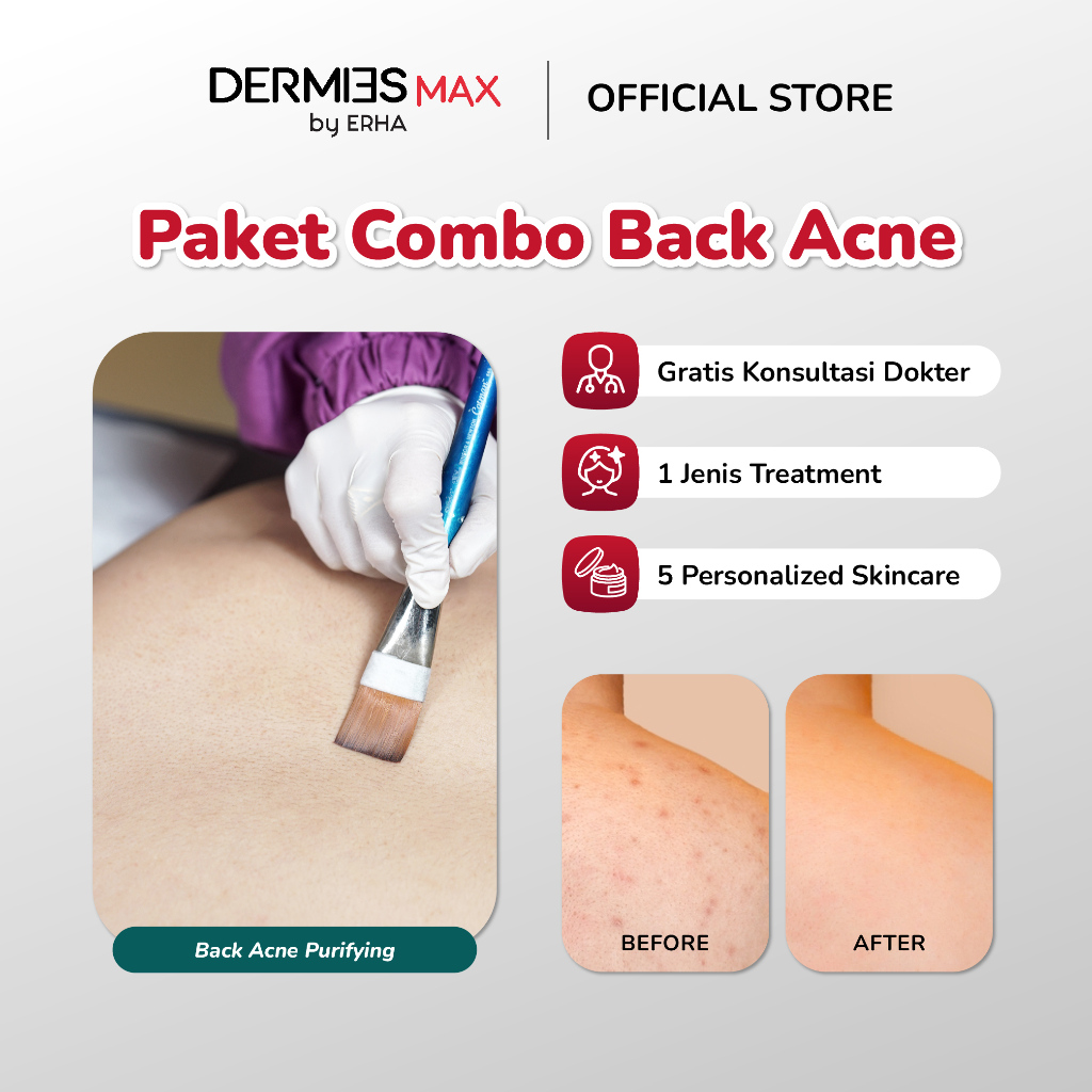 Jual Dermies Max Paket Combo untuk Back Acne | Shopee Indonesia