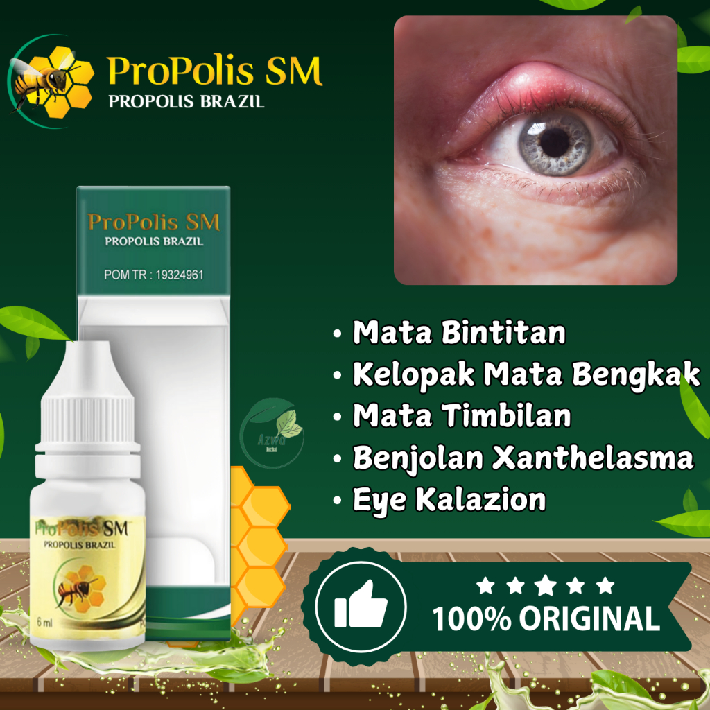 Jual Obat Bintitan Benjolan Di Kelopak Mata Bengkak Mata Kalazion Mata ...