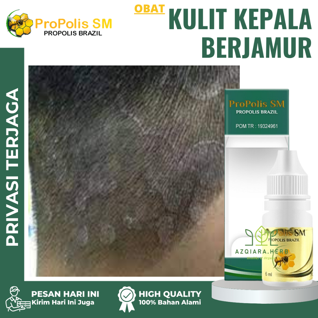 Jual Obat Kepala Gatal Berjamur, Obat Kepala Borok, Obat Ketombe berkerak Dengan Propolis SM Isi ...