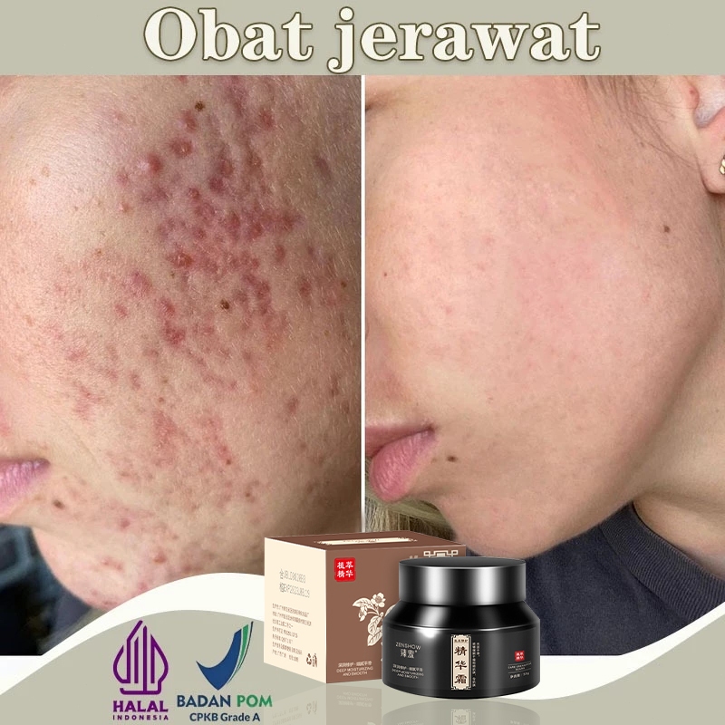 Jual Salep jerawat, penghilang bekas jerawat hitam, menghilang bekas ...