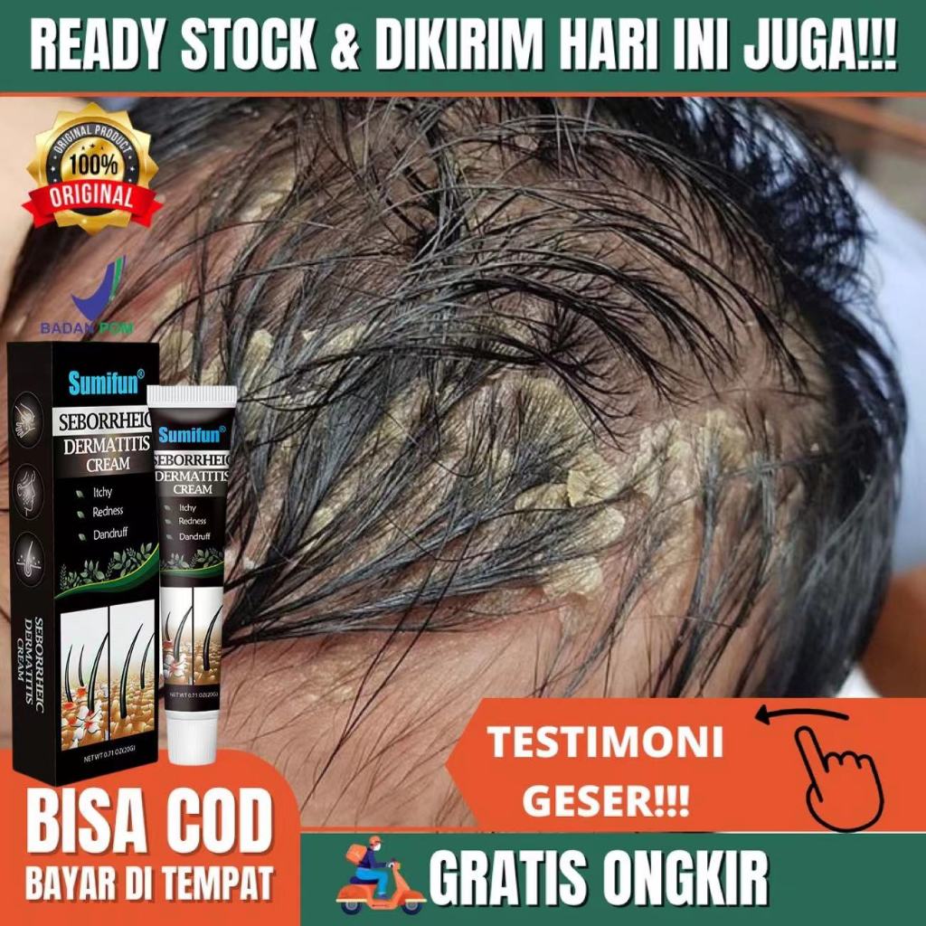 Jual Sumifun obat gatal kepala ketombe Obat Psoriasis Parah Gatal Kulit Kepala 20g Obat Koreng ...