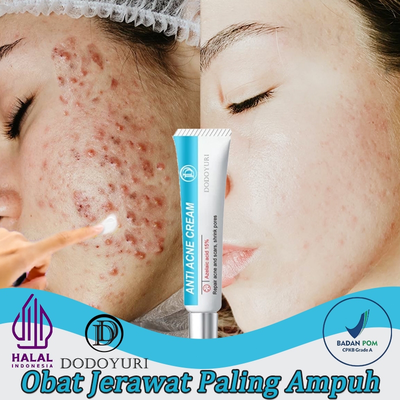 Jual Menghilangkan bekas jerawat Salep jerawat Penghilang bekas jerawat ...