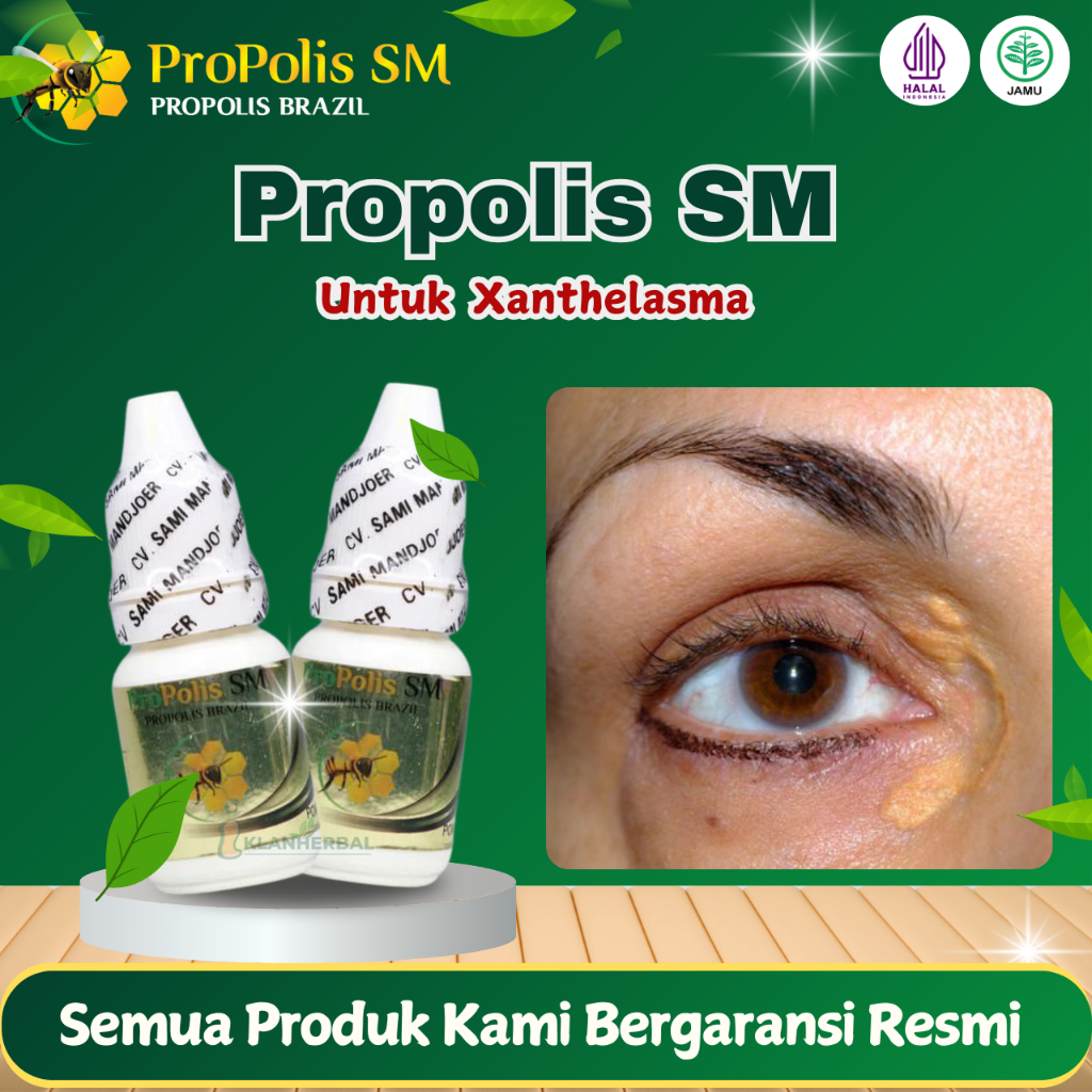 Jual Obat Gumpalan Lemak Di Kelopak Mata, Salep Penghilang Xanthelasma ...