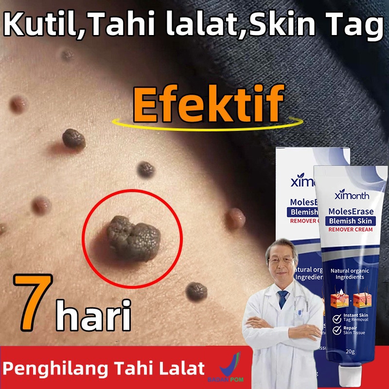 Jual Obat kutil paling ampuh Salep kutil Obat penghilang kutil 20g Obat ...