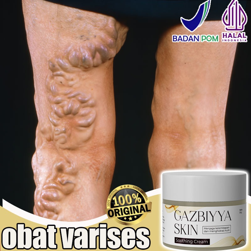 Jual Obat varises Varicose veins cream Cream varises paling ampuh ...