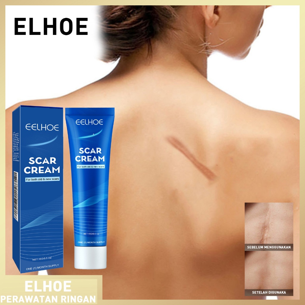 Jual Scar Removal Cream Repairing Pock Mark Burn Surgical Scar Cesarean ...