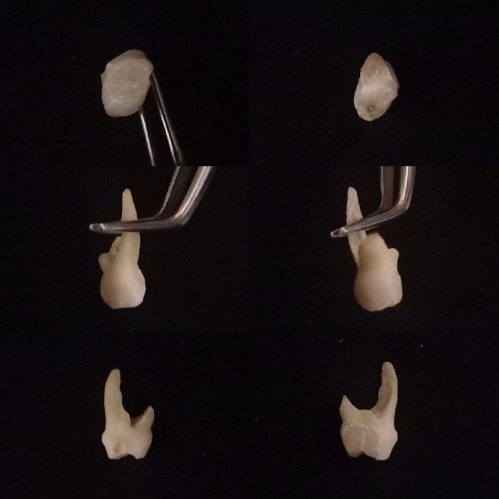 jual-gigi-54-m1-kanan-ra-anak-molar-1-kanan-rahang-atas-pedodonti