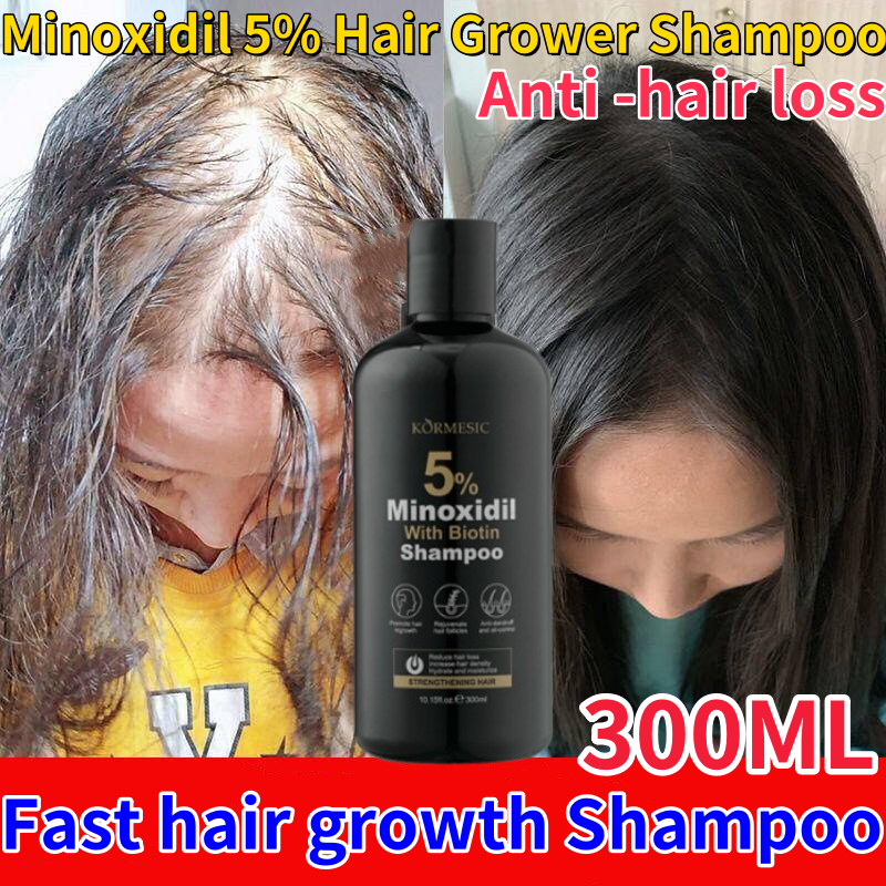 Jual 5% Minoxidil Penumbuh Rambut Cepat 300ml Penumbuh Rambut Anti Rambut Rontok Botak Ginger ...