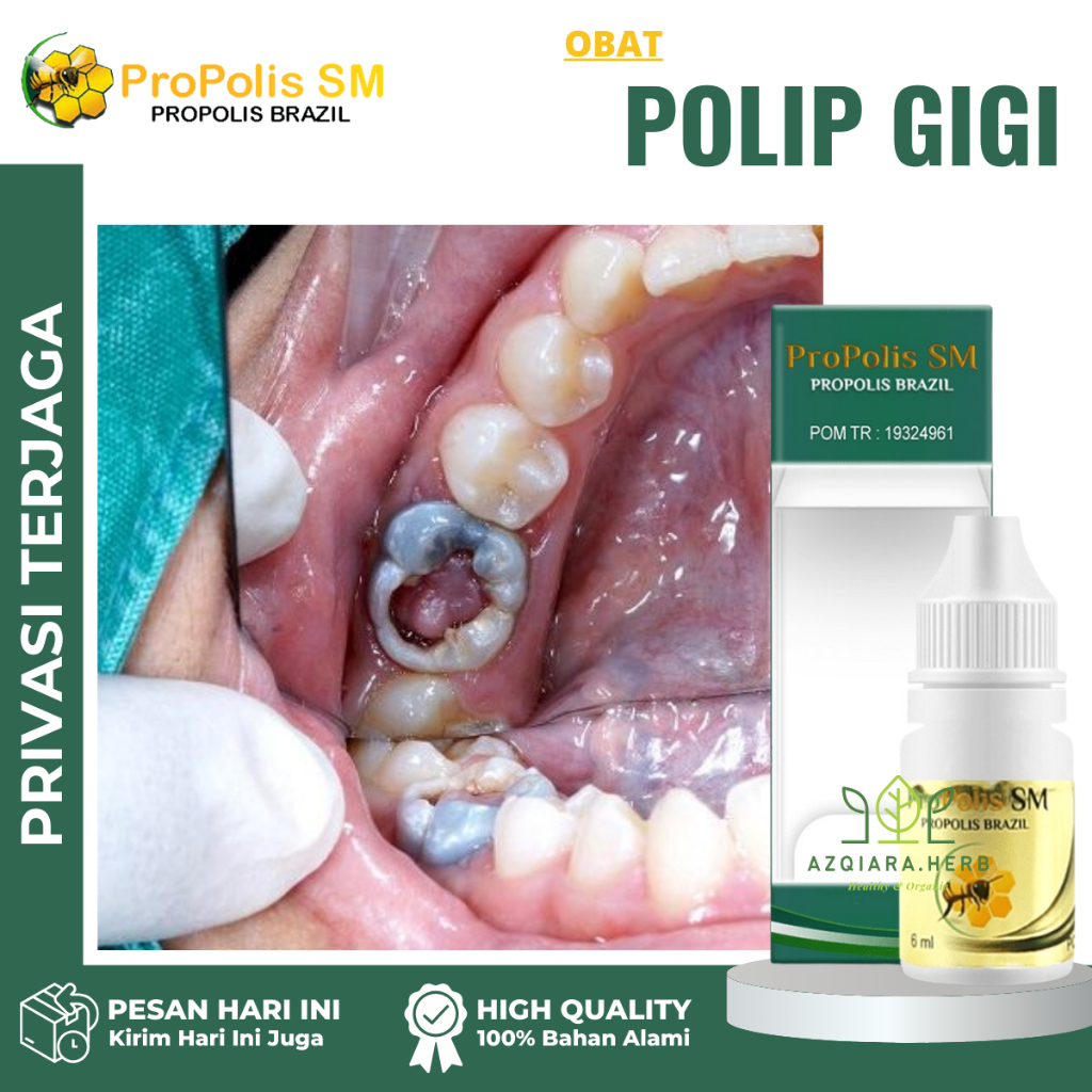 Jual Obat Polip gigi, Obat Gusi Bengkak, Obat Abses Gusi, Obat Benjolan ...