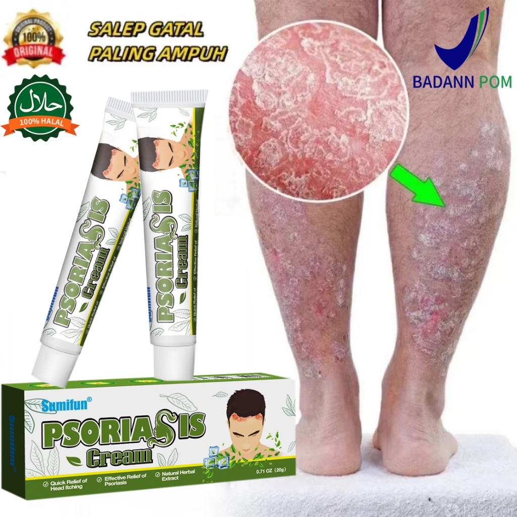 Jual Salep Psoriasis yang Paling Efektif Salep Eksim Salep gatal Obat ...