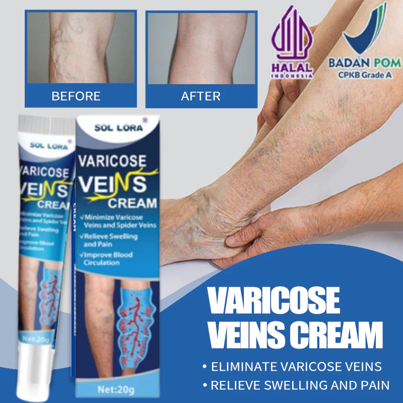 Jual Varicose Veins Cream 20g Varicose Veins Obat Varises Di Kaki Dan ...