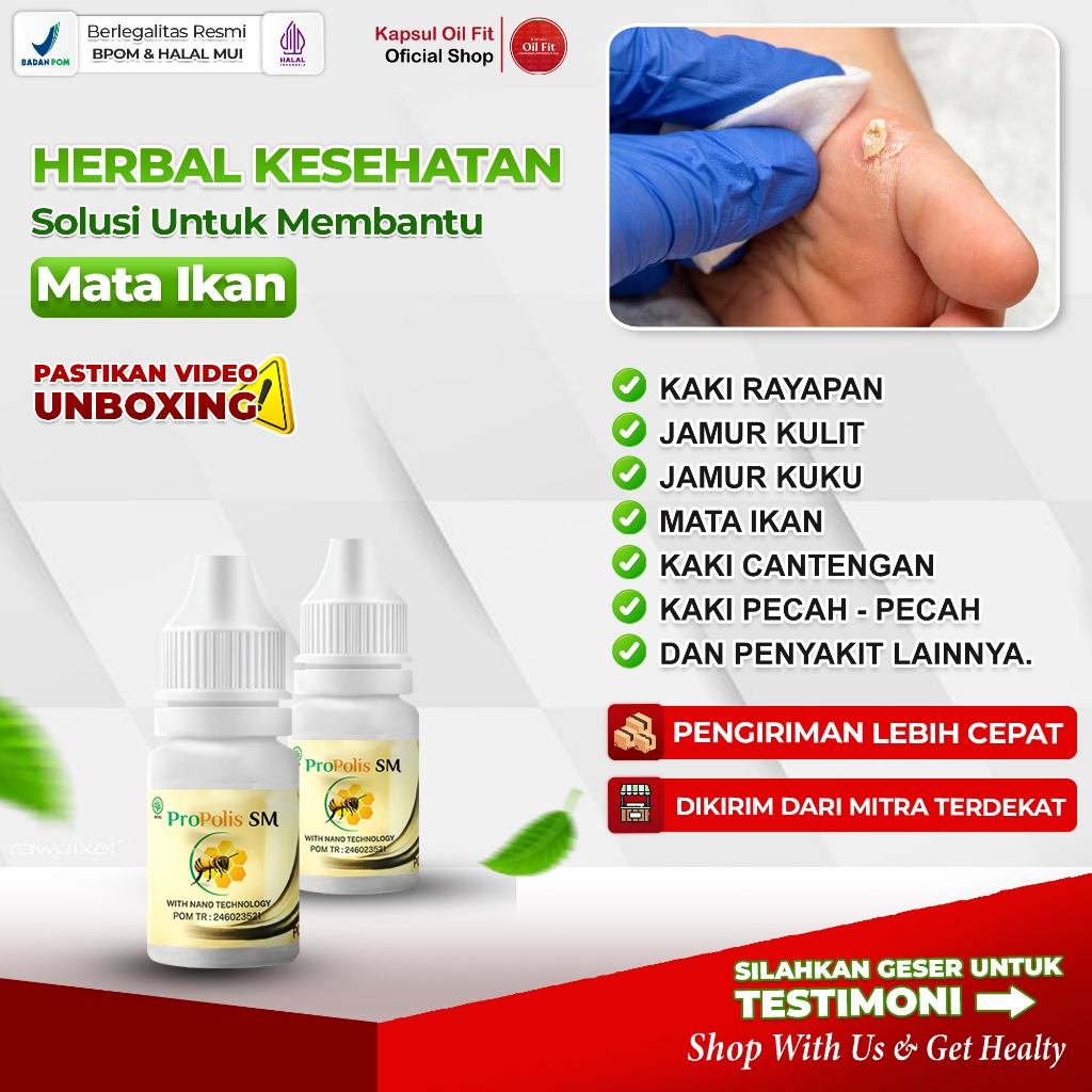 Jual Obat Tetes Mata Ikan Di Telapak Kaki Dan Tangan Penghilang ...