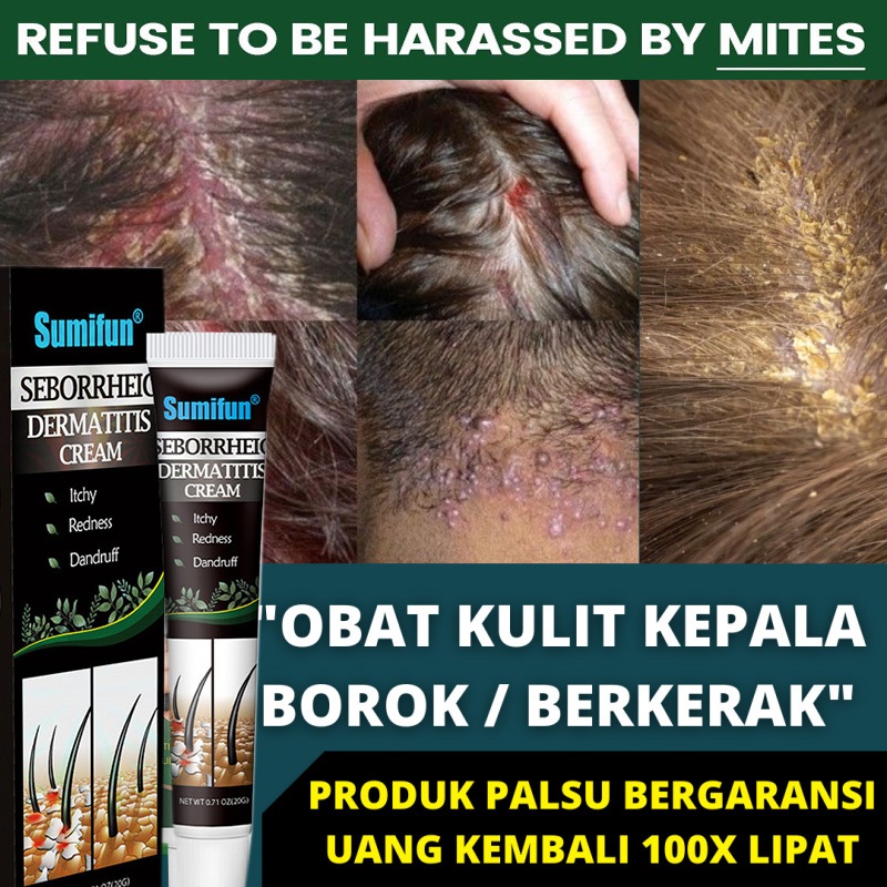 Jual OBAT KETOMBE PARAH Scalp Itching Anti itching cream Obat Psoriasis di Kepala Eksim Kulit ...