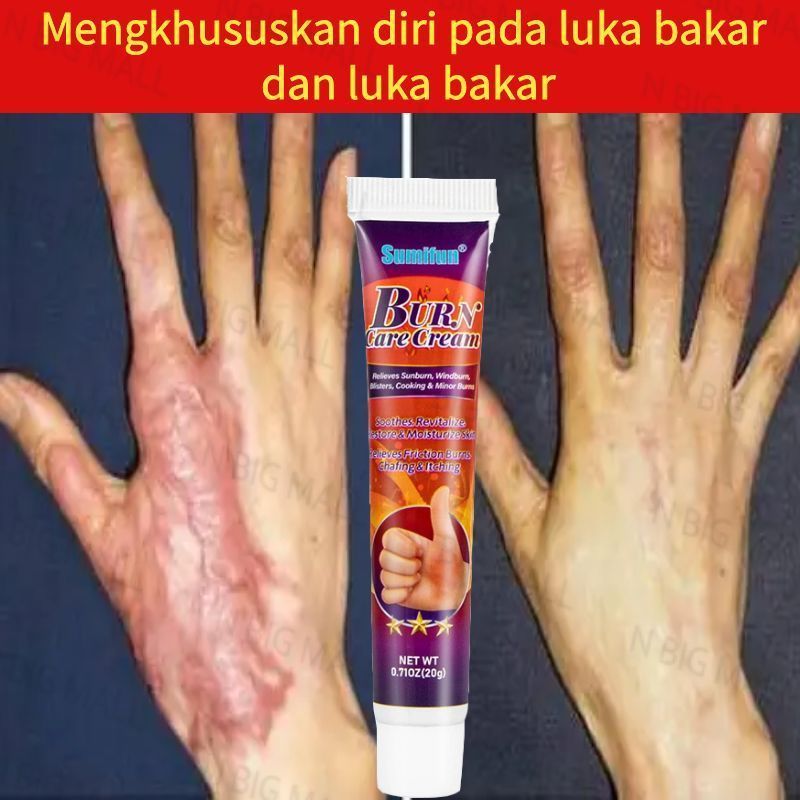 Jual Salep Luka Bakar Salep Bekas Luka Obat Luka Bakar Obat Penghilang ...