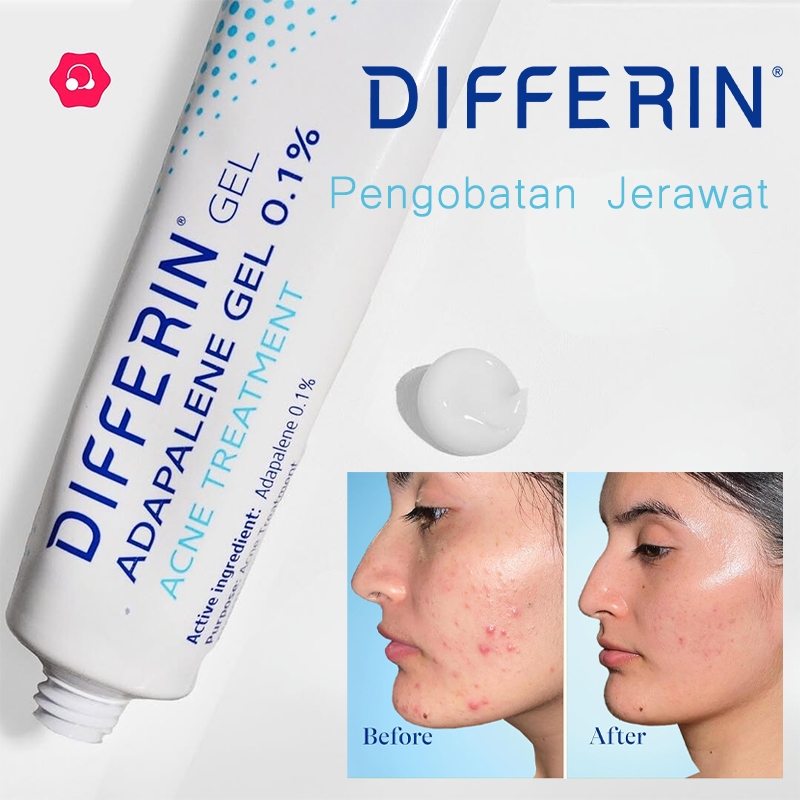 Jual Differin Acne Treatment Gel 15gr | Pengobatan Jerawat | 0.1% ...