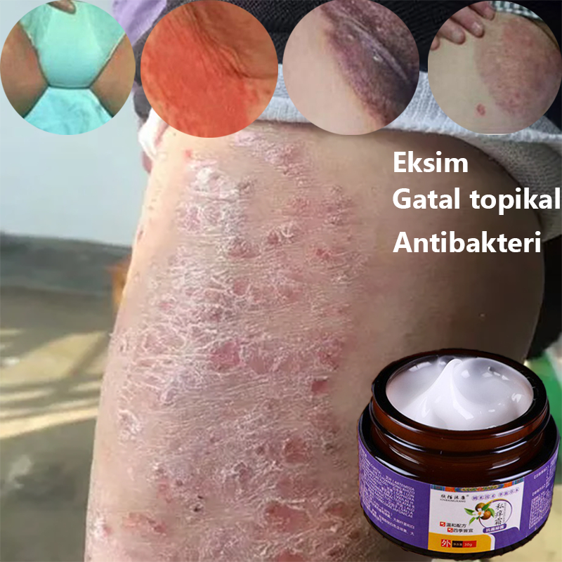 Jual Obat Gatal Selangkangan Salep Gatal Paling Ampuh Anti Jamur Obat ...