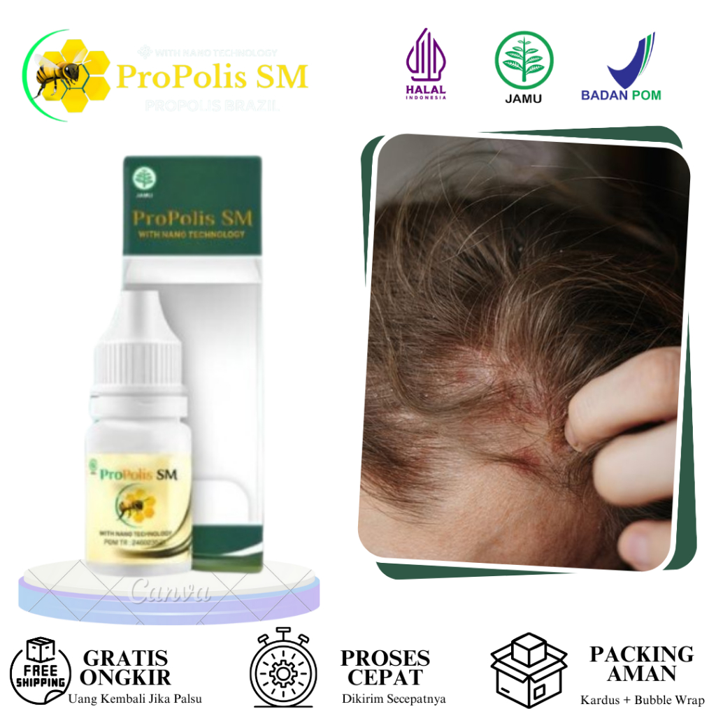 Jual Obat Koreng Borok Di Kulit Kepala Psoriasis Kulit Kering Bersisik Dermatitis Seboroik Tinea ...
