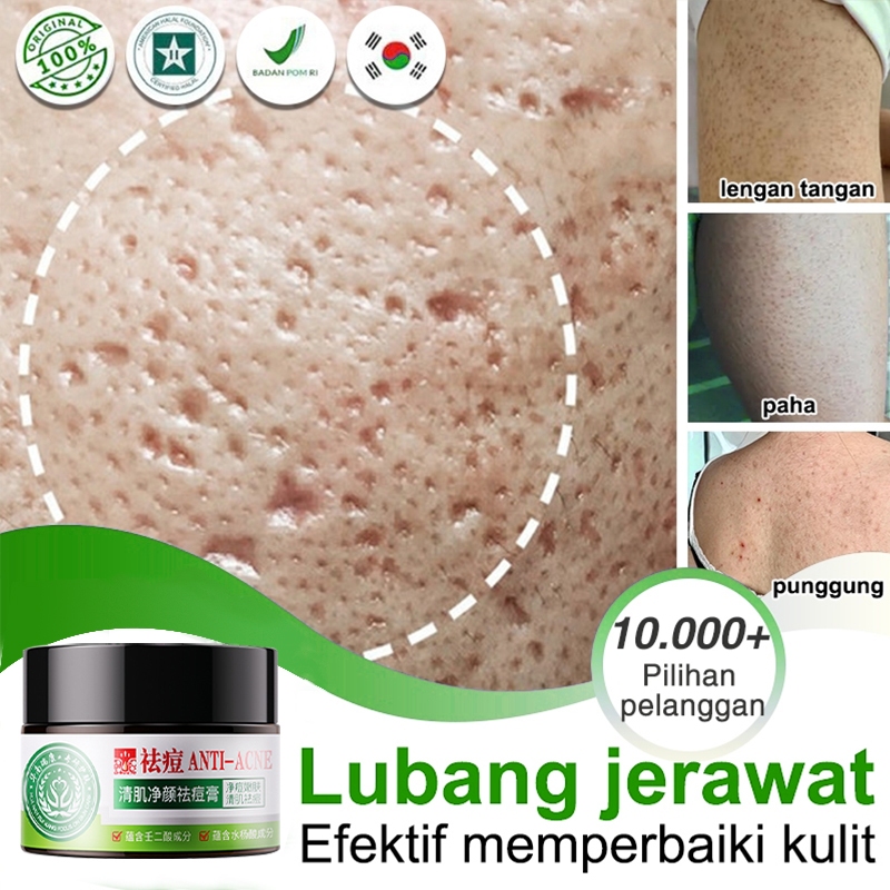 Jual Cream jerawat, menghilangkan jerawat, jerawat parah, memperbaiki ...