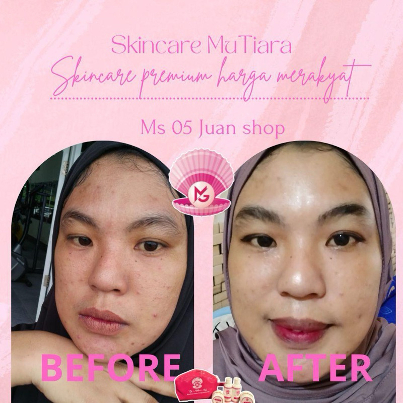 Jual CREAM MUTIARA | mencerahkan menghilangkan bekas jerawat | Shopee ...