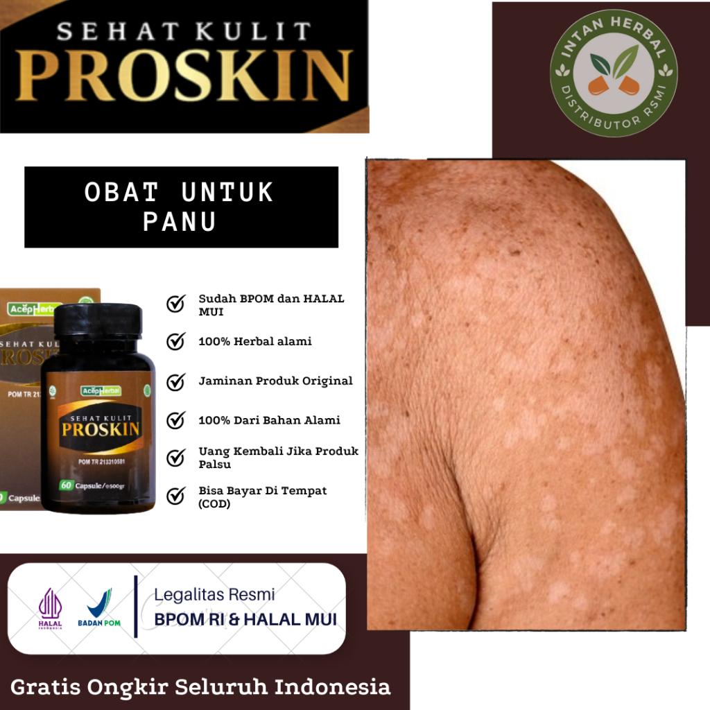 Jual Obat Panu, Panu Di Wajah Punggung, Jamur Kulit Panu, Panu Kadas ...