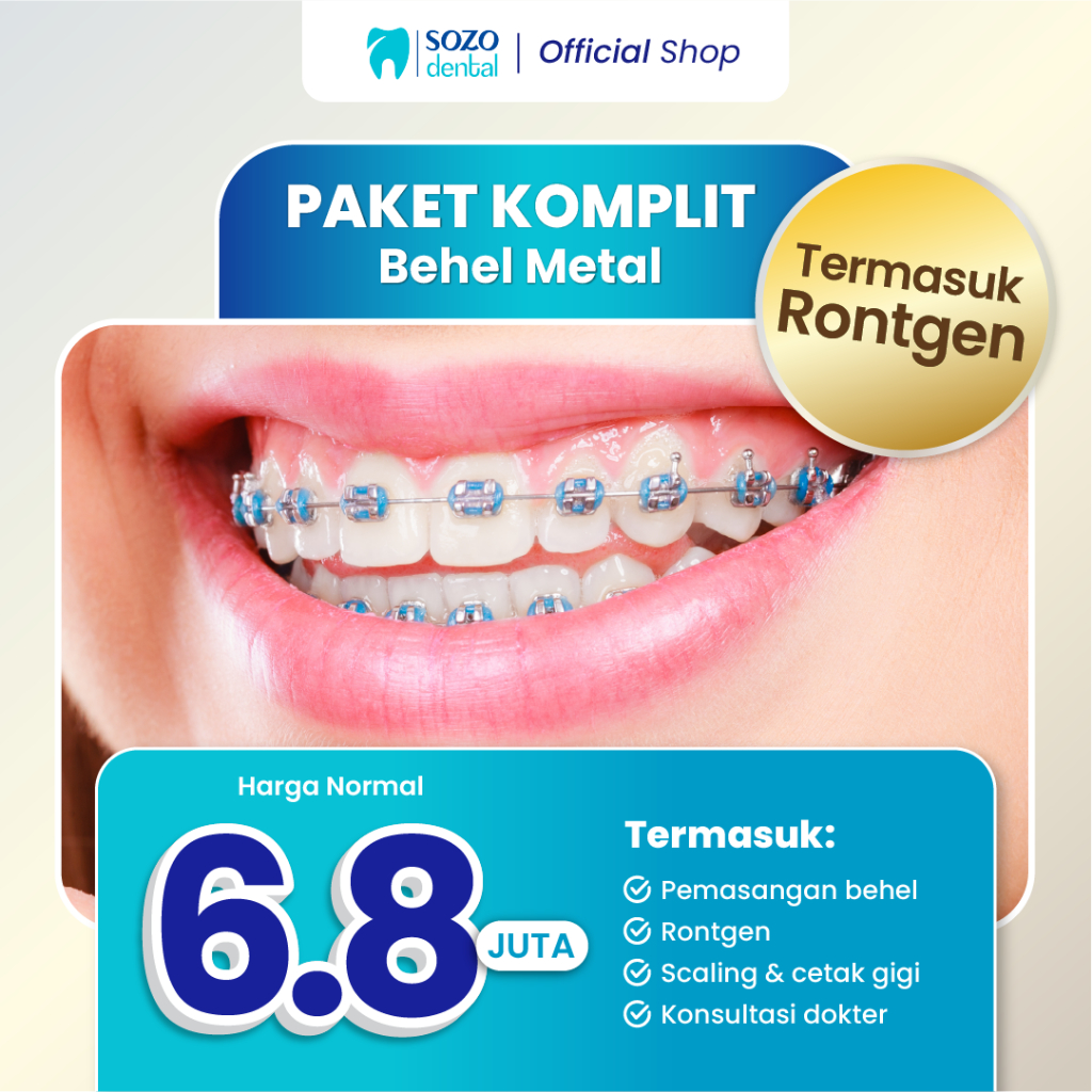 Jual Paket Behel Metal Basic Komplit: Pemasangan Rahang Atas dan Bawah, Rontgen, Basic Scaling ...